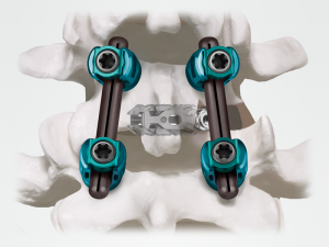 ALTERA™ Product Page - Expandable Technology