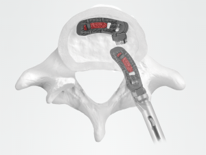 ALTERA™ Product Page - Expandable Technology