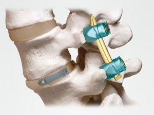 CALIBER™ Product Page - Expandable Technology