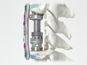 Fortify VA™ Product Page - Expandable Technology