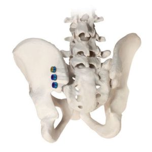 Minimally Invasive Sacroiliac Joint Fusion | Globus Medical
