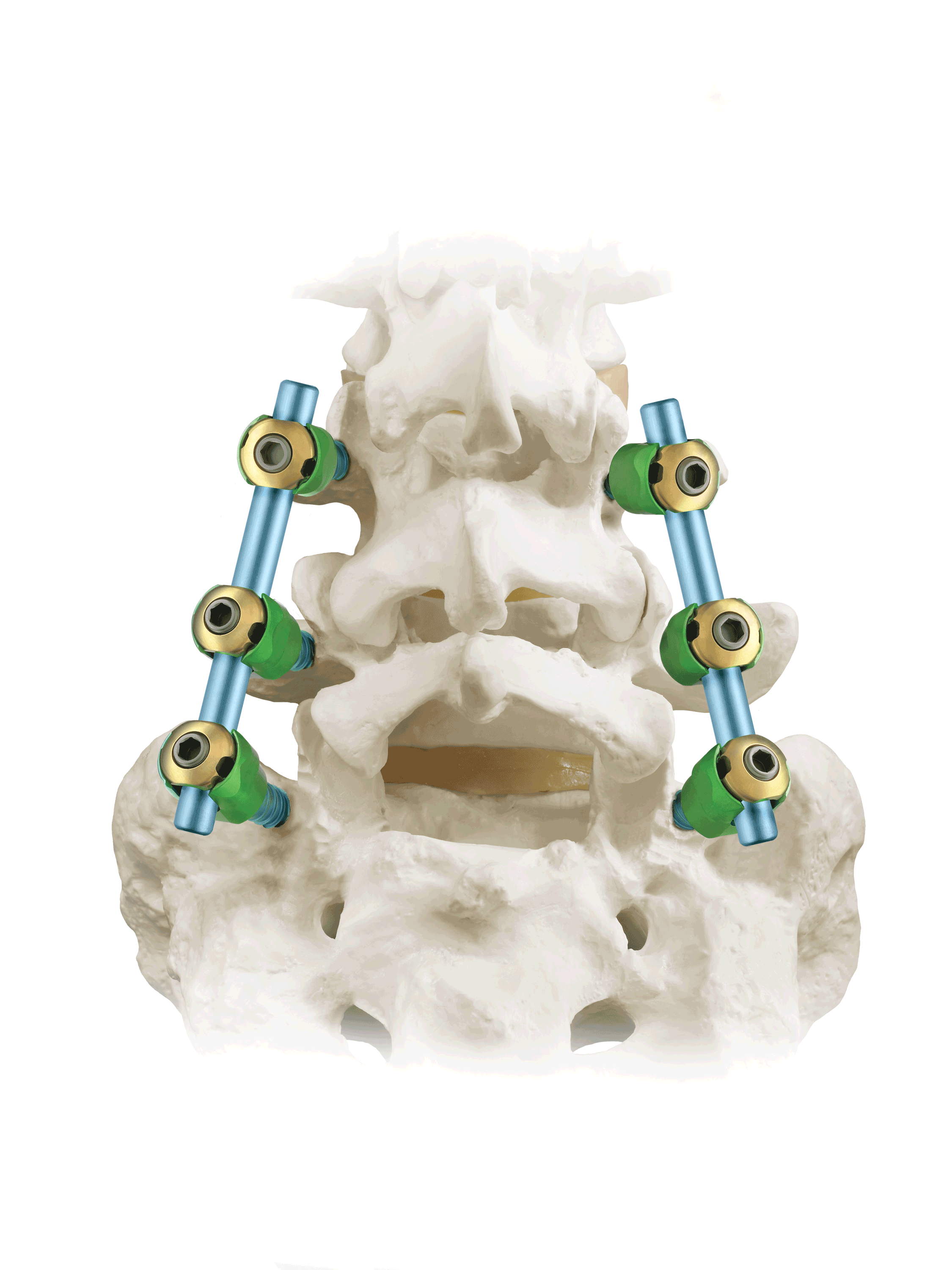 PROTEX™ Posterior Stabilization System | Globus Medical