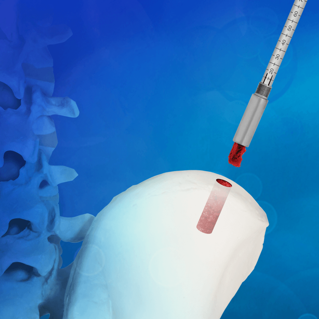 RETRIEVE™ Bone Graft Harvest System | Globus Medical