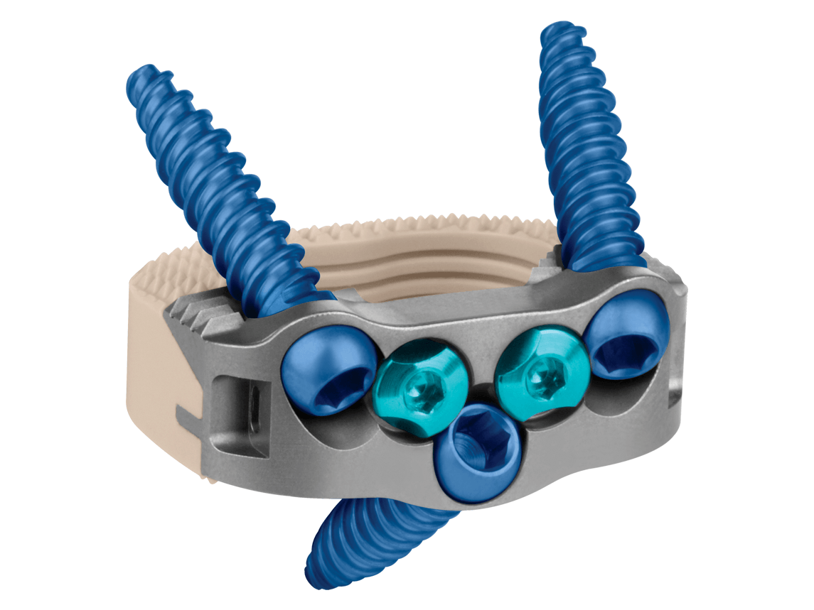 INDEPENDENCE™ Integrated ALIF Spacer | Globus Medical