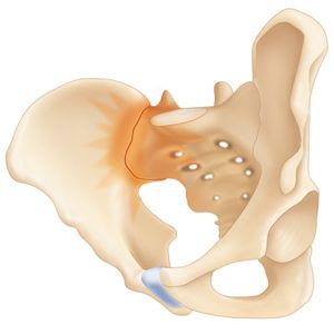 Minimally Invasive Sacroiliac Joint Fusion | Globus Medical