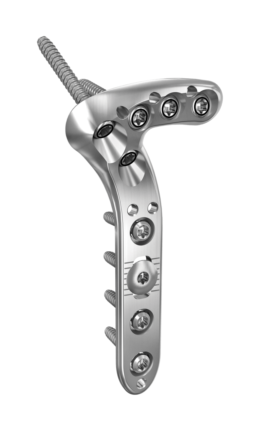 ANTHEM® Distal Radius Fracture System | Globus Medical