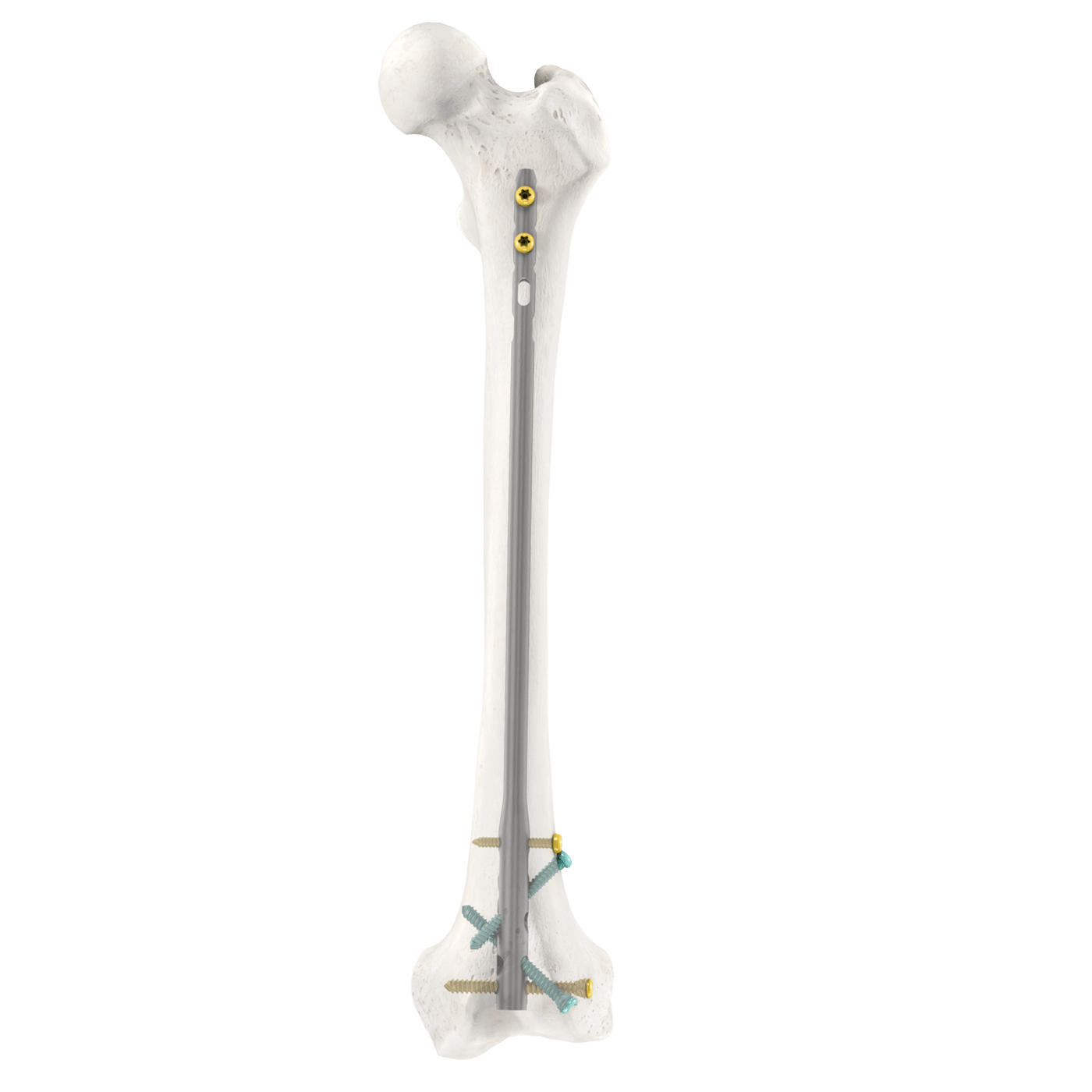 AUTOBAHN® Femoral Nailing System | Globus Medical