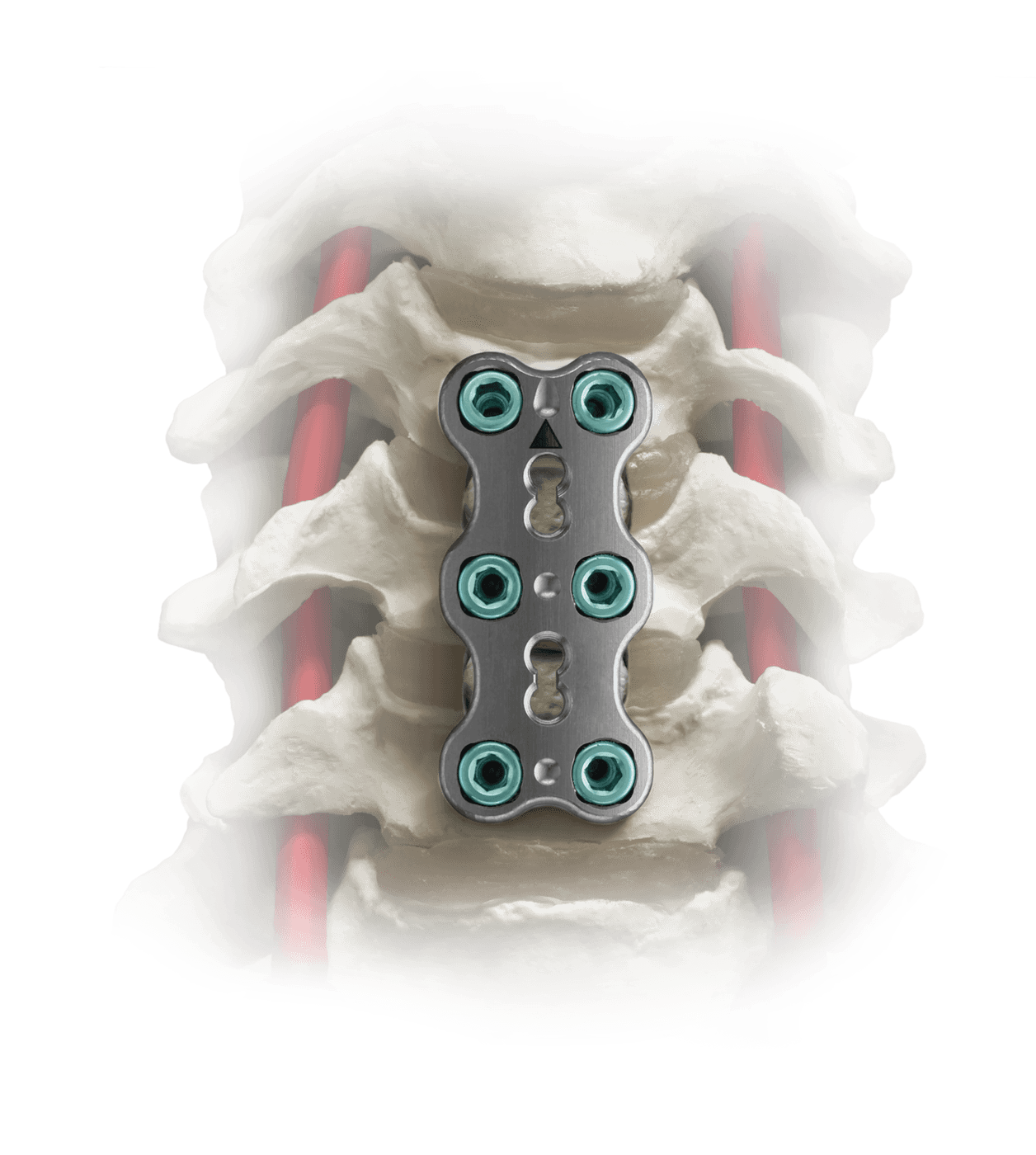 ASSURE® Anterior Cervical Plates | Globus Medical