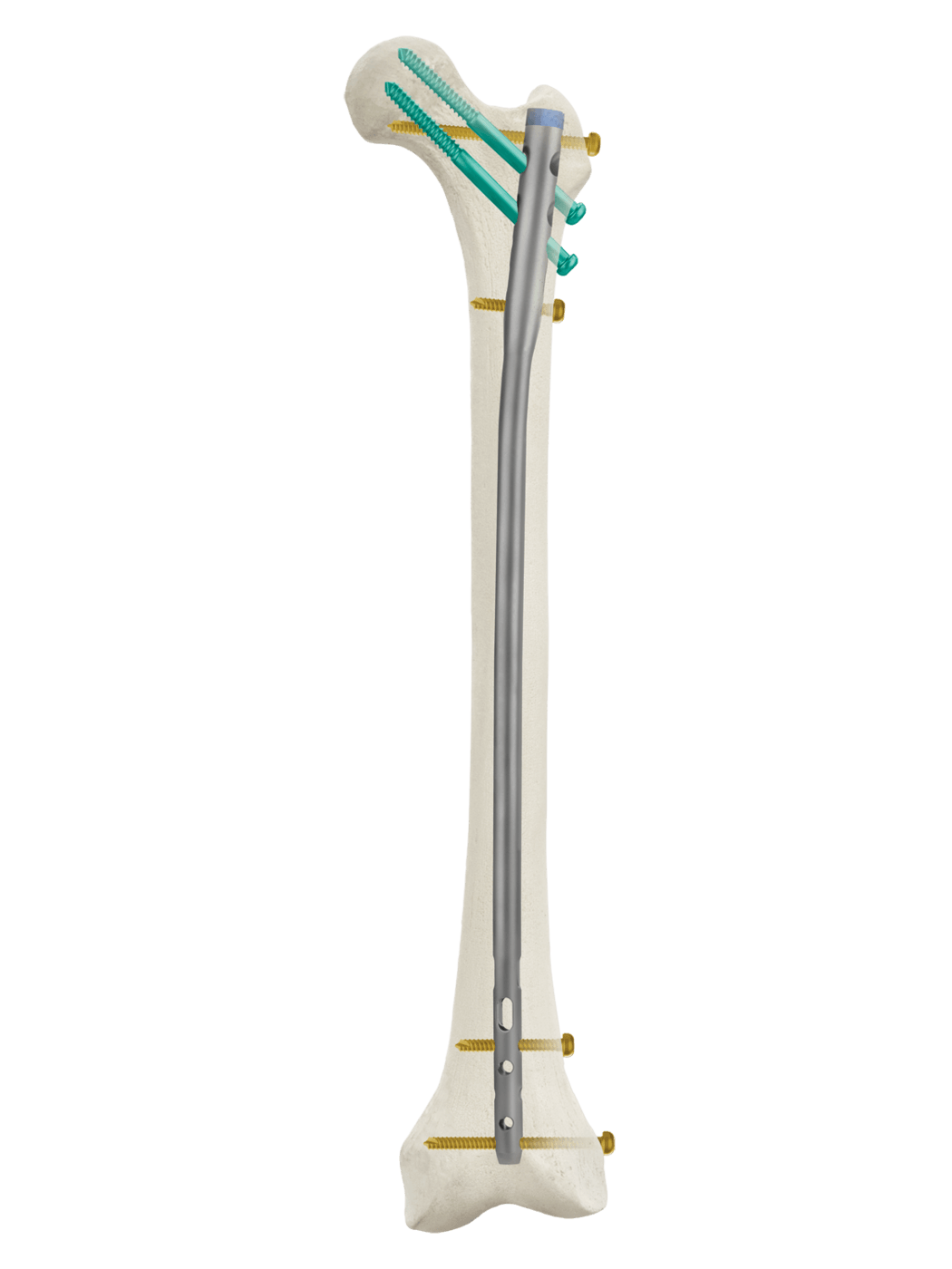 AUTOBAHN® Tibial Nailing System | Globus Medical