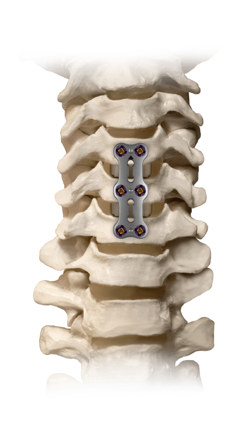ASSURE®-X Anterior Cervical Plates | Globus Medical