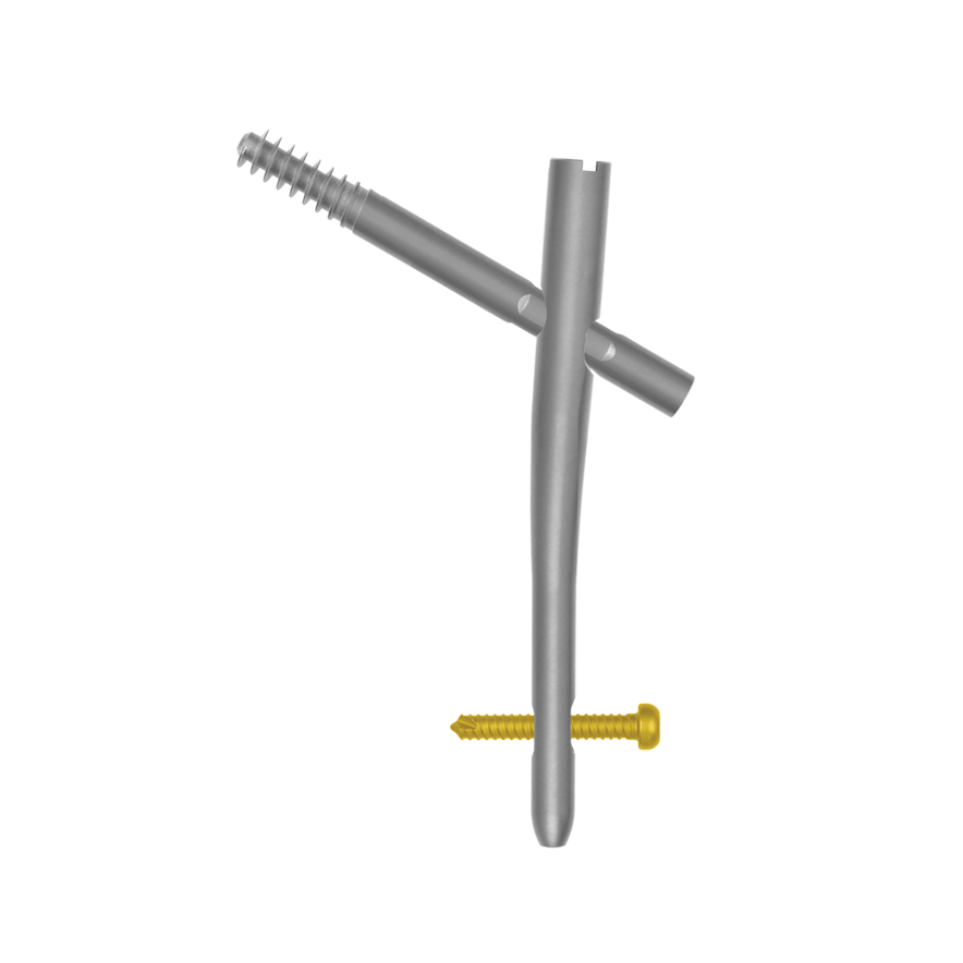 AUTOBAHN™ Trochanteric Nailing System | Globus Medical