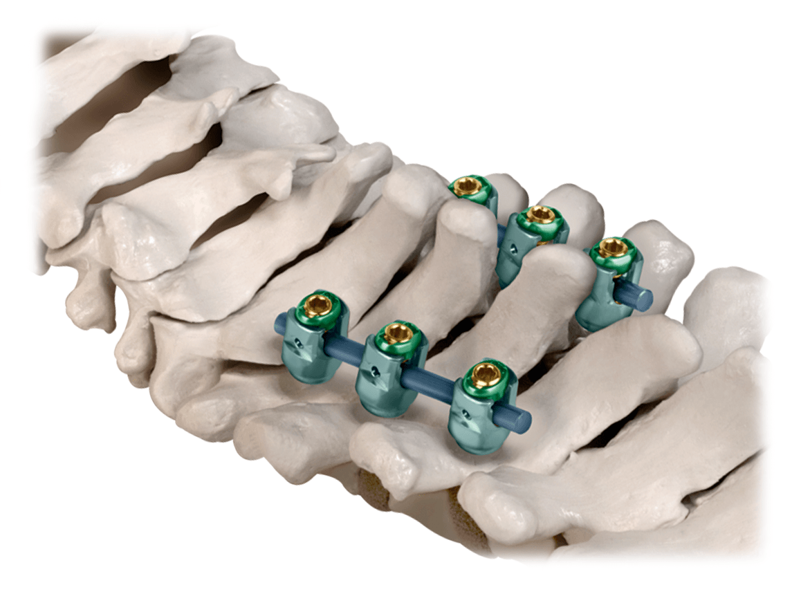 CAPITOL™ MIS Cervico-Thoracic Stabilization System | Globus Medical