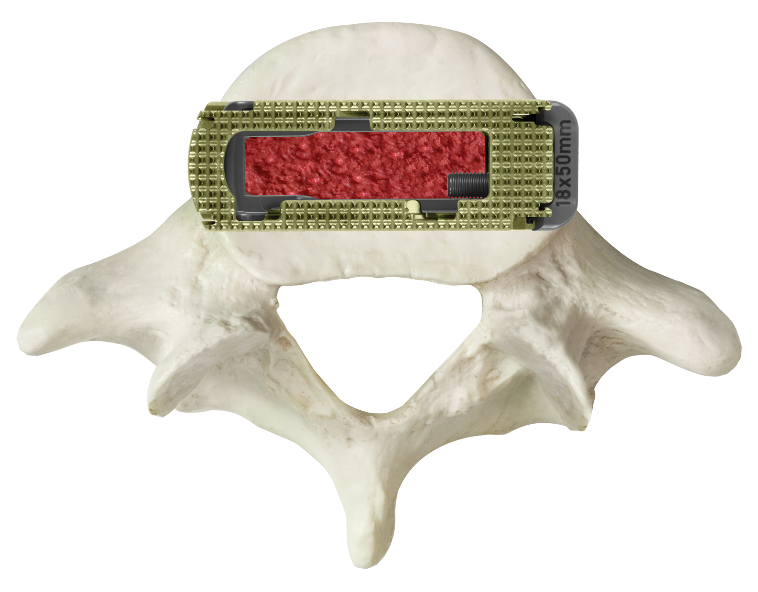 Lateral Lumbar Interbody Fusion Surgery | Globus Medical