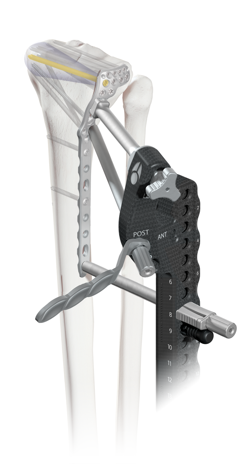 ANTHEM® Proximal Tibia Fracture System | Globus Medical