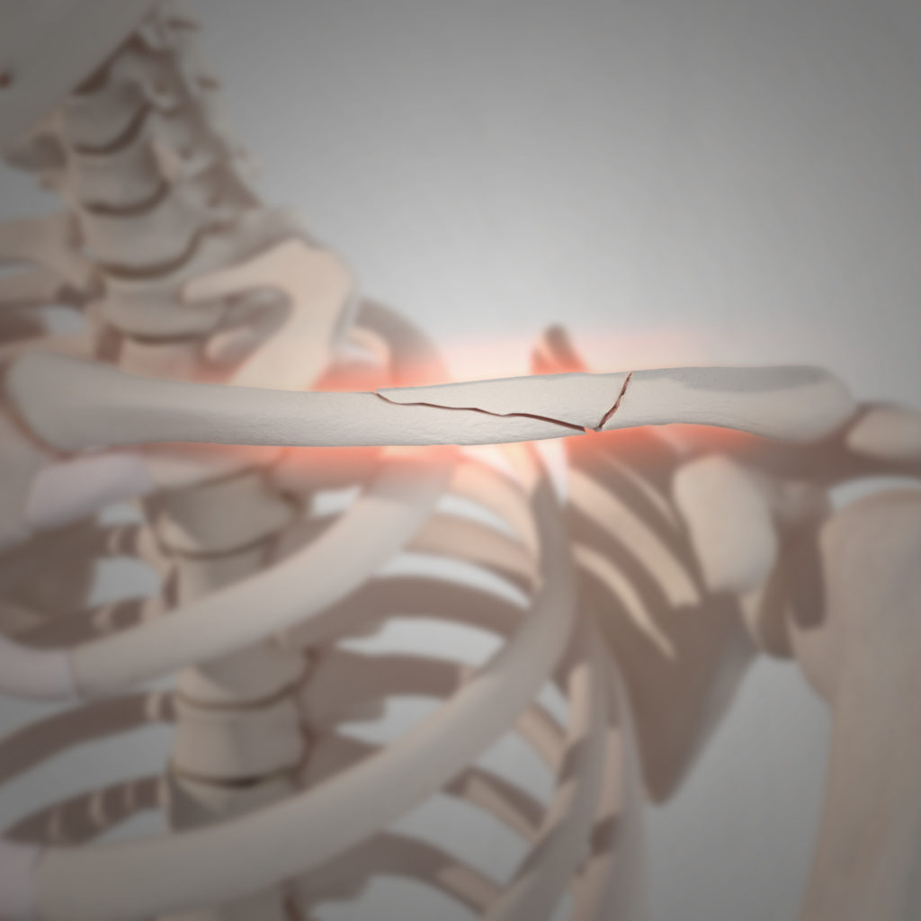 Bone Fracture Types and Symptoms | Globus Medical