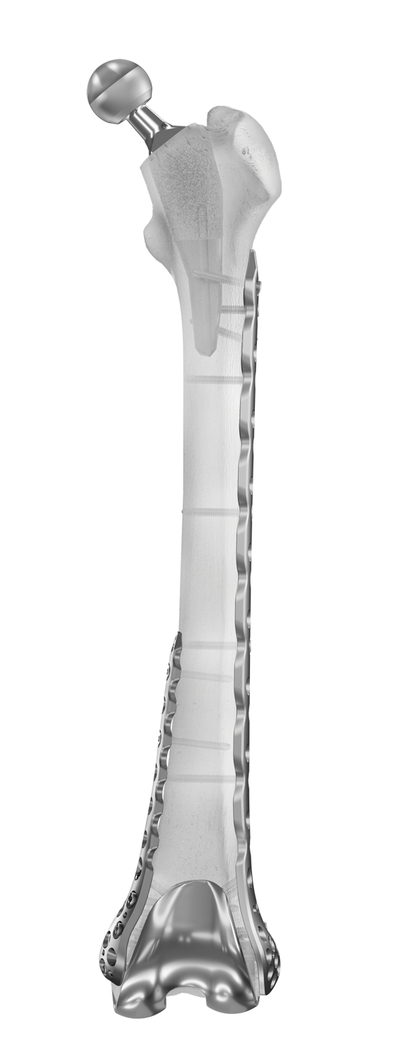ANTHEM® Distal Femur Fracture System | Globus Medical