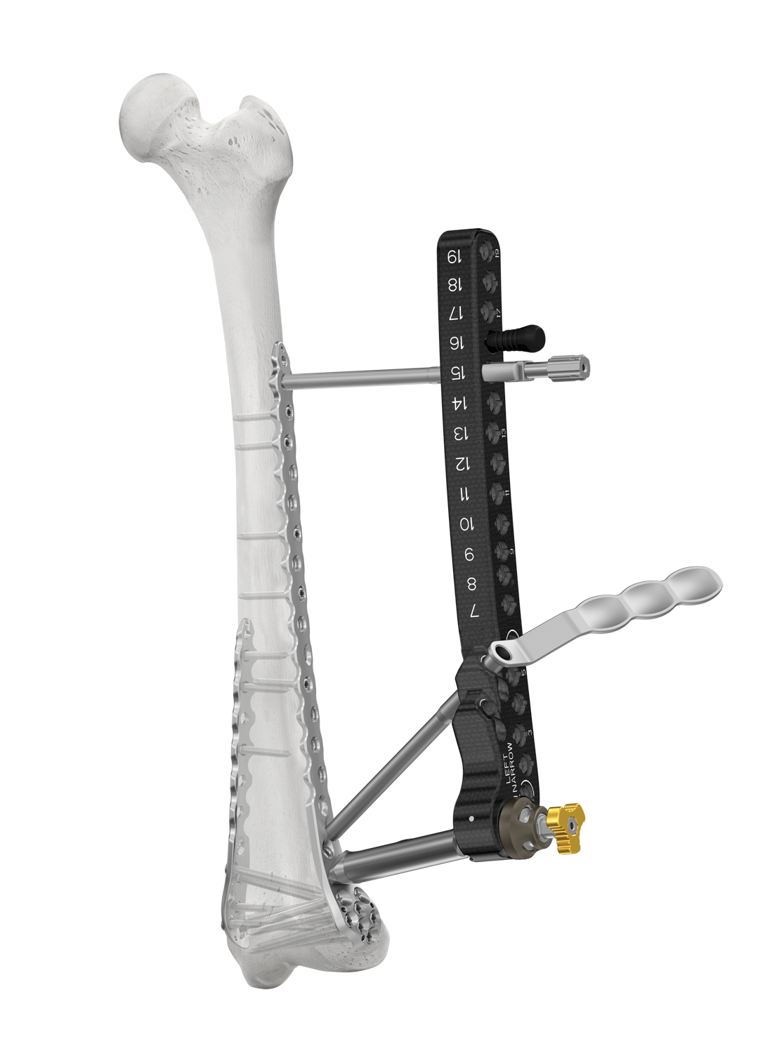 ANTHEM® Distal Femur Fracture System | Globus Medical