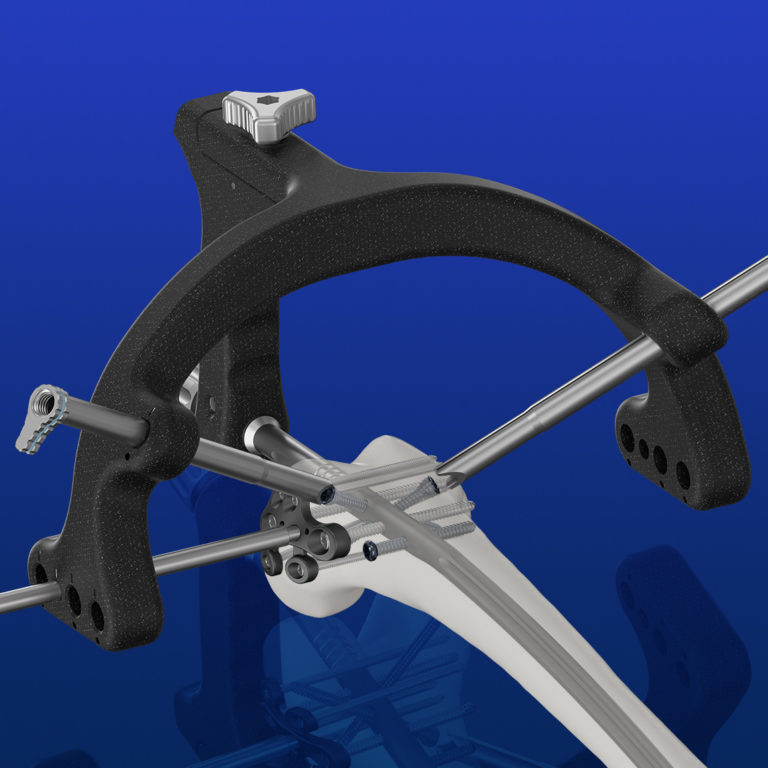 AUTOBAHN™ EVO Retrograde Femoral Nailing System | Globus Medical