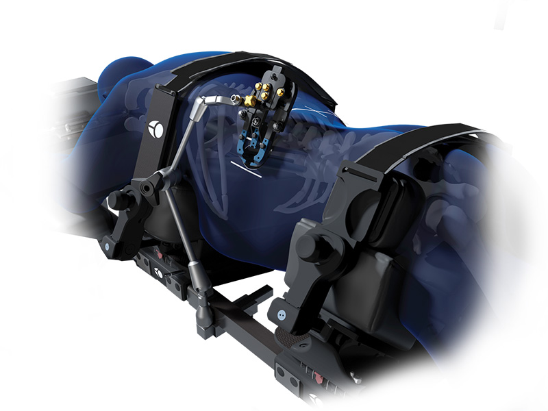 Prone Lateral Patient Positioning System | Globus Medical