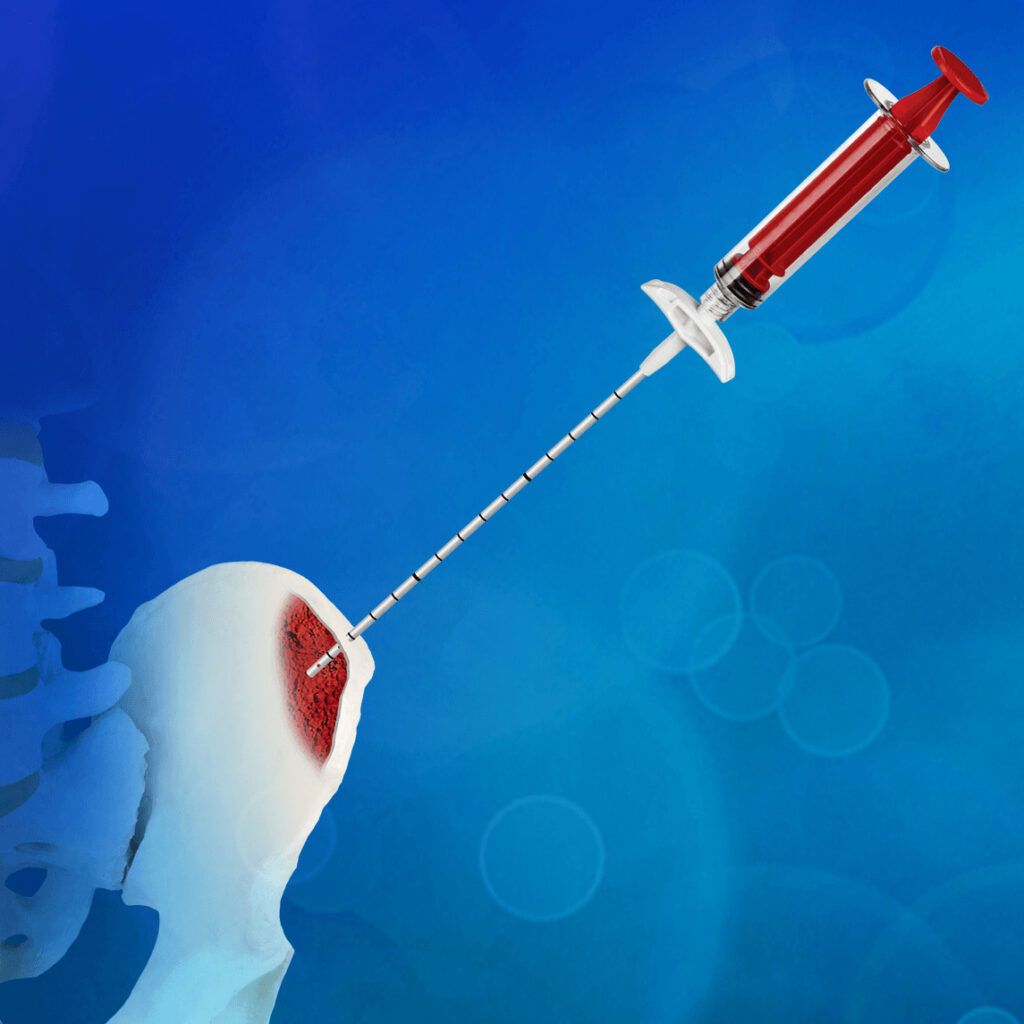 RETRIEVE™ Bone Marrow Aspirate (BMA) Kit | Globus Medical